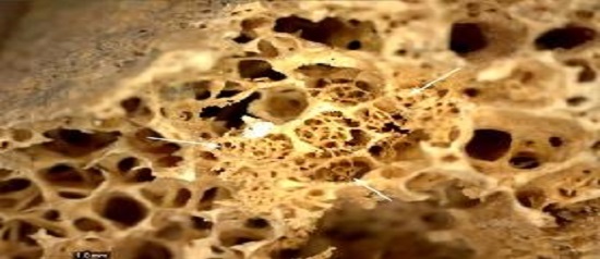 Ancient cancer victim first in archeological record - News - Nature ...